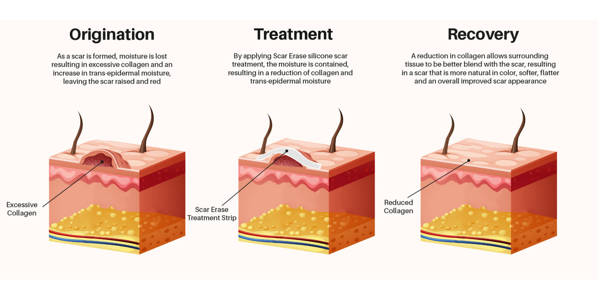 One Skincare Product You Didn't Know About But Need to... | Scar Erase